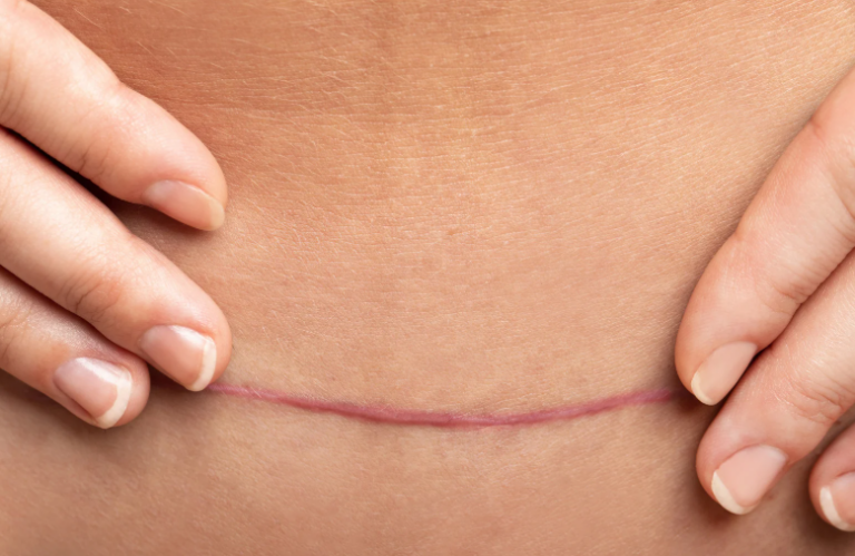 21) Physiotherapy After Abdominal Surgery: How to Protect and keep ...